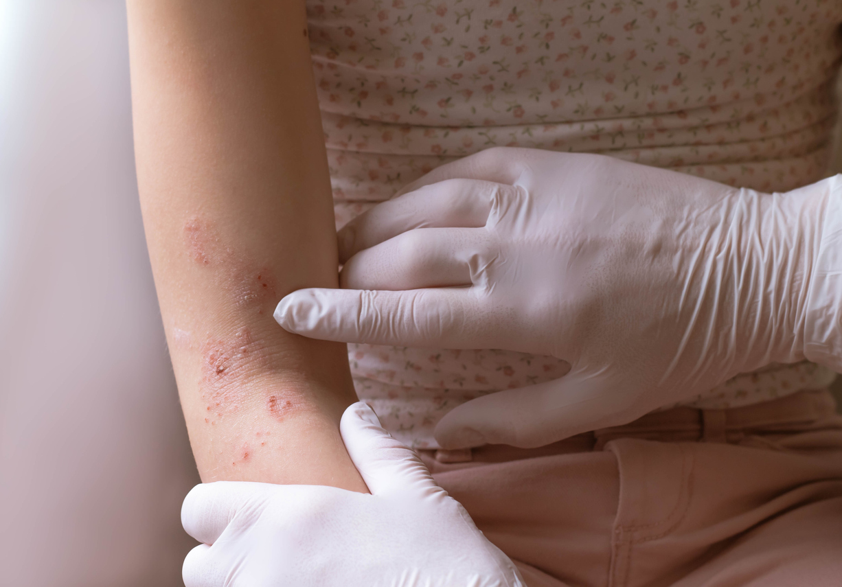 Atopic Dermatitis Linked To Higher Risk Of IBD | NaturalHealth365